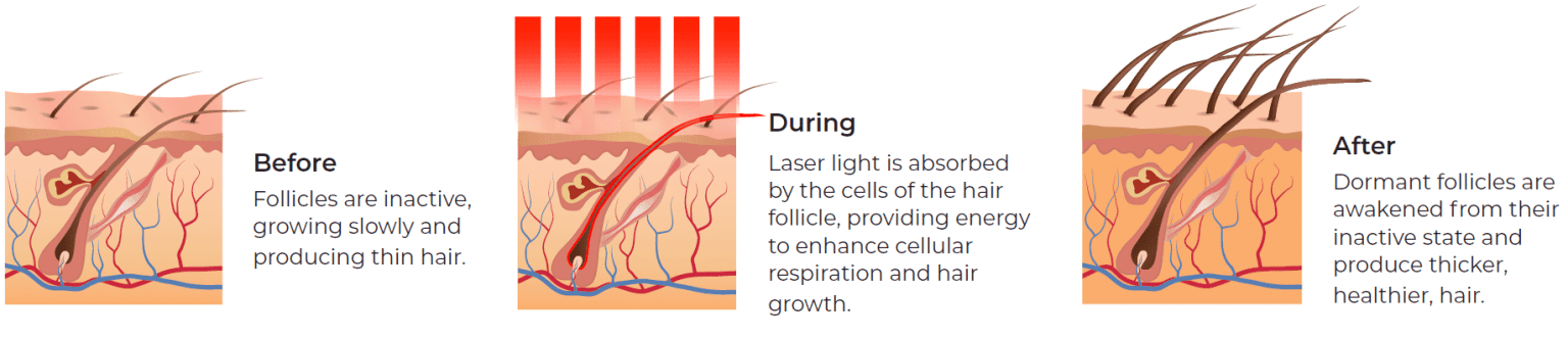 LaserCap HD - LaserCap